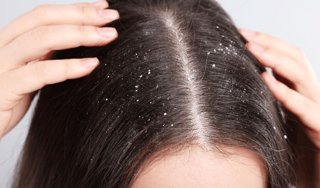 How to Get Rid of Dandruff: Best Treatments and Remedies